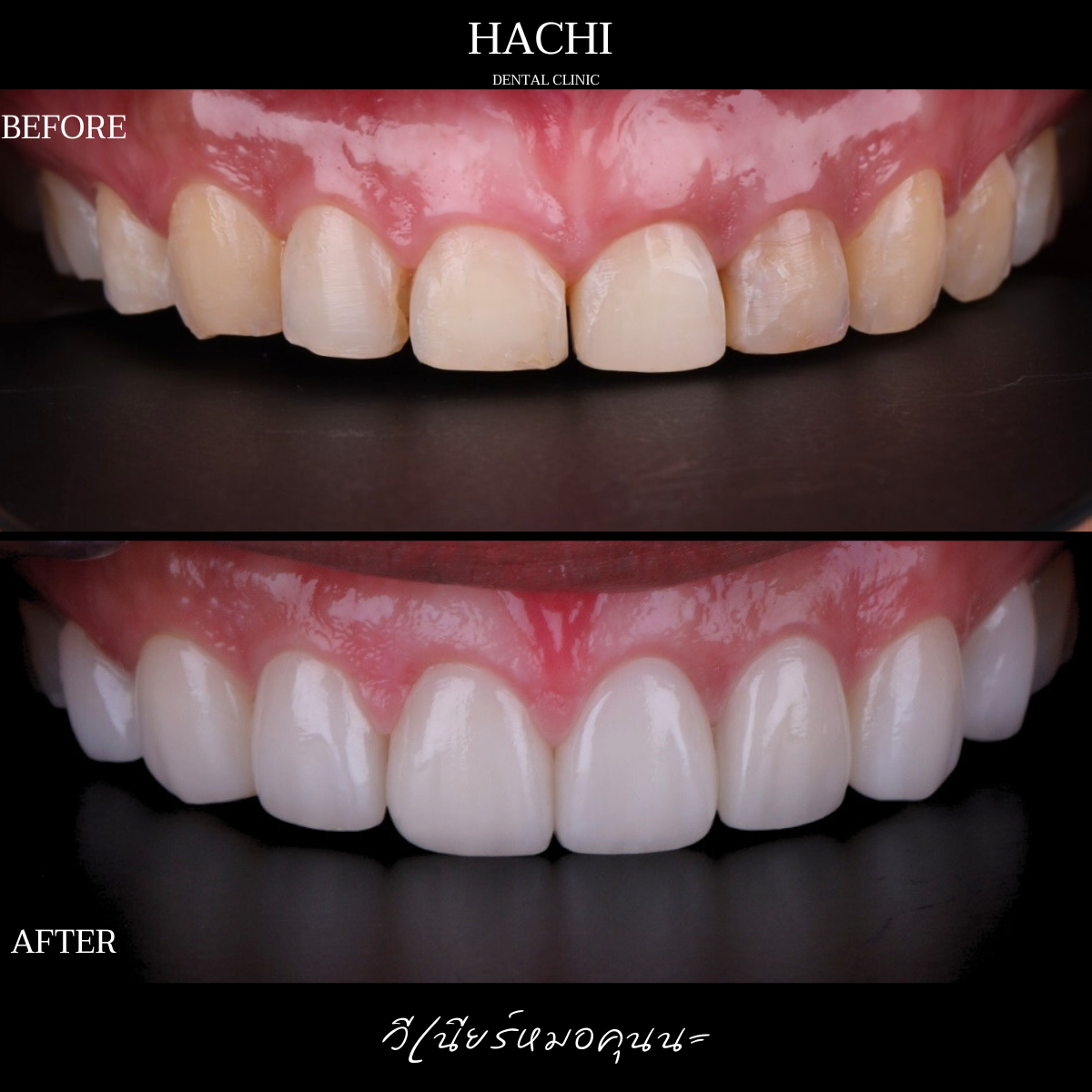 Veneer-CH - คลินิกทันตกรรมฮาชิ